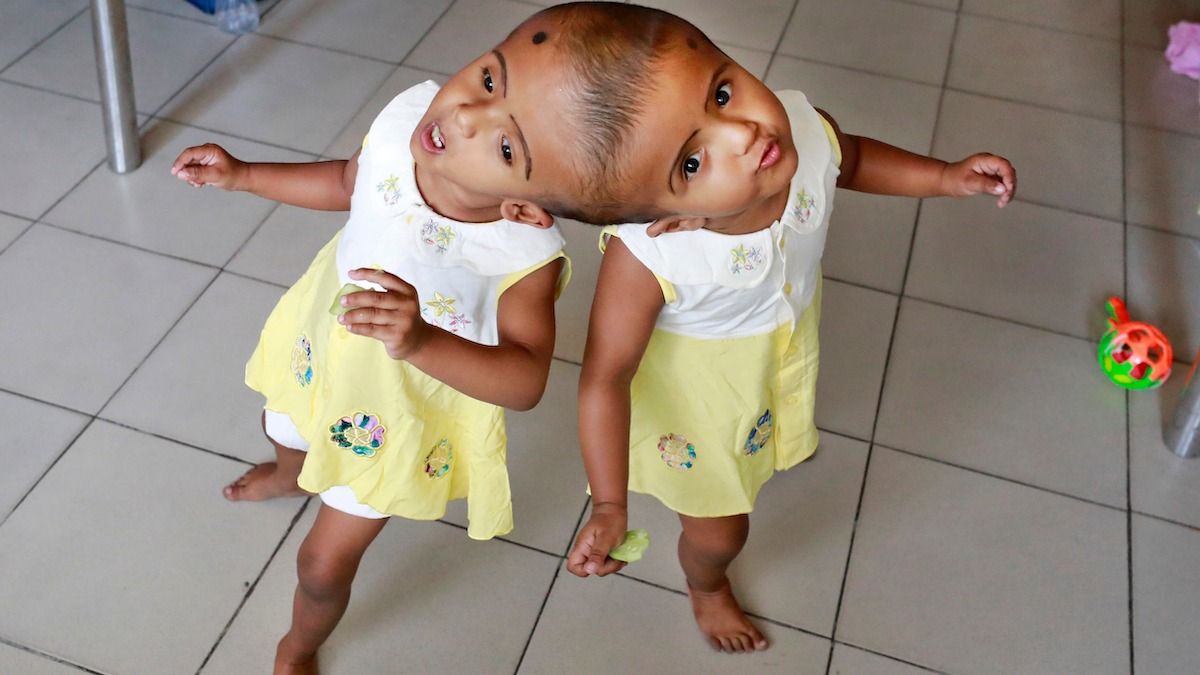 Man rejects conjoined twins; step-brother says, 'you don't deserve a ...