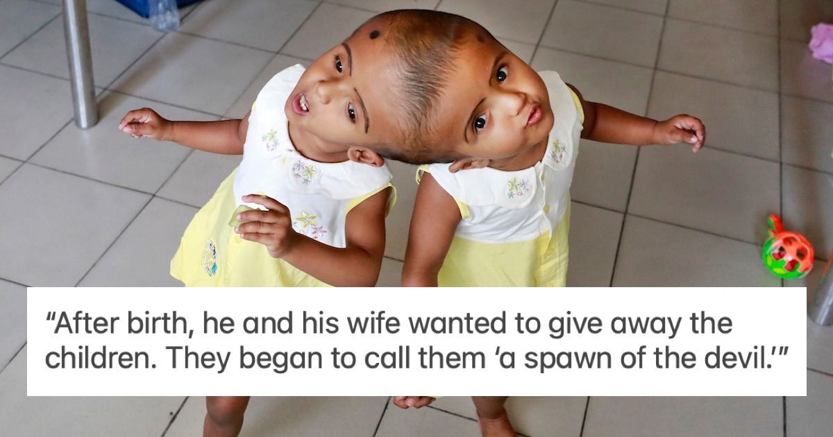 Man rejects conjoined twins; step-brother says, 'you don't deserve a ...